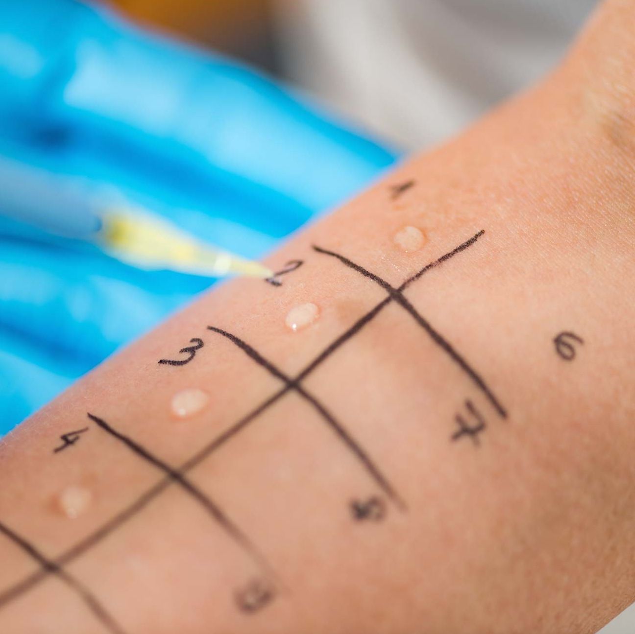 Allergietest | Hautarzt Dr. Detlev Pirkhammer, 1090 Wien